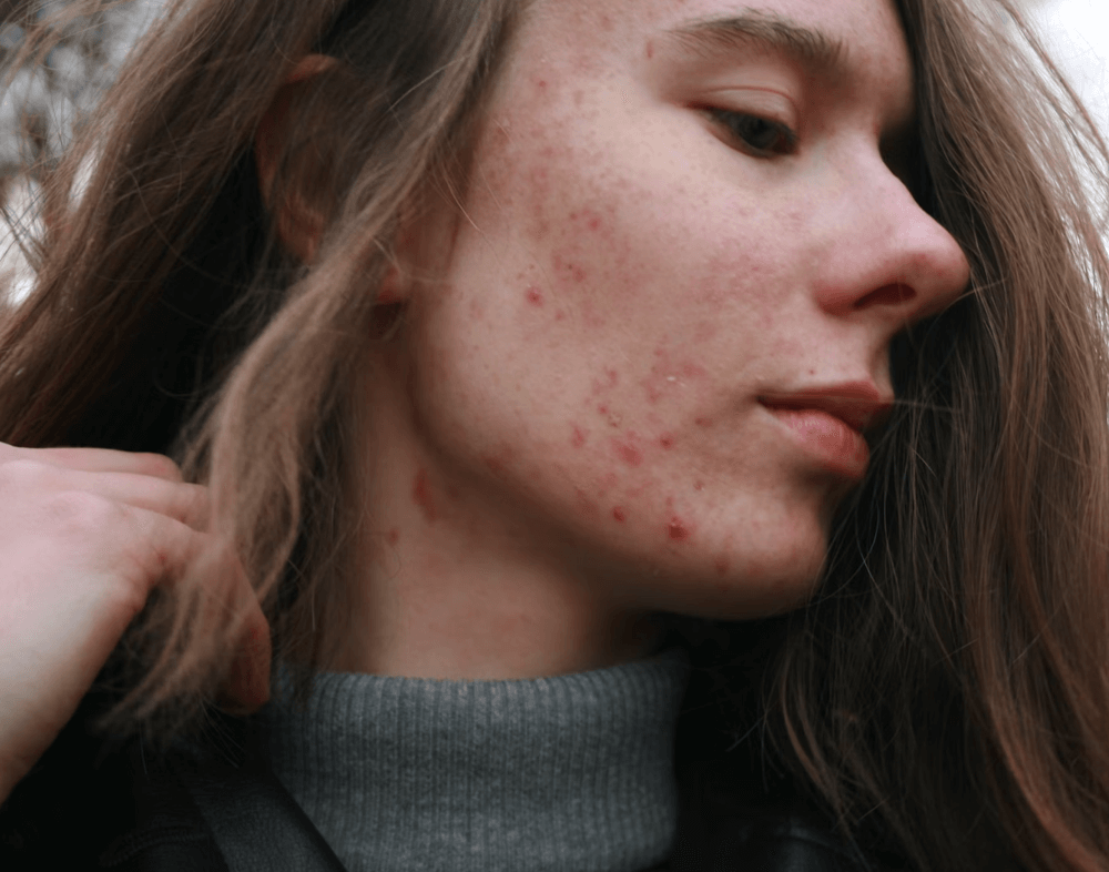 How to Avoid Menstrual Acne – Bacterial Vaginosis Women's Health Wellness